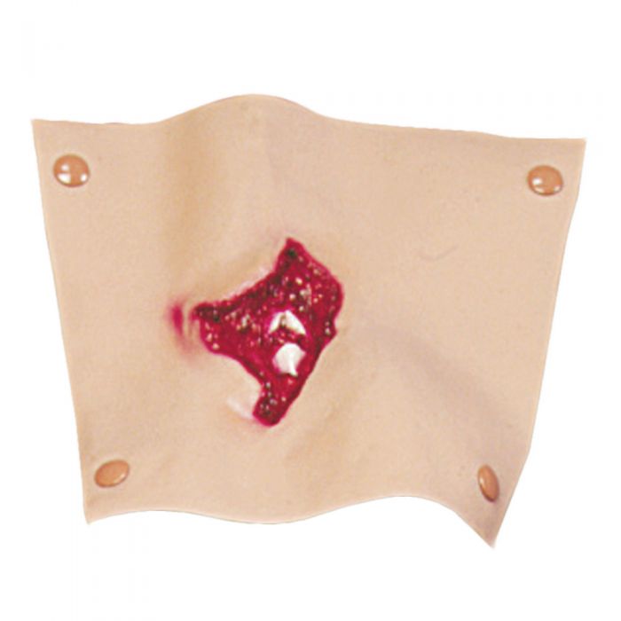 Simulaids Bleeding Moulage (Compound Fracture of Humerus) – MedTree